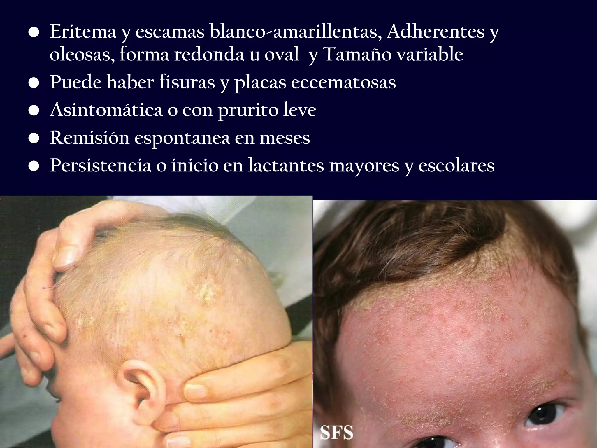 dermatitis seborreica, acne vulgar y rosacea | PPT