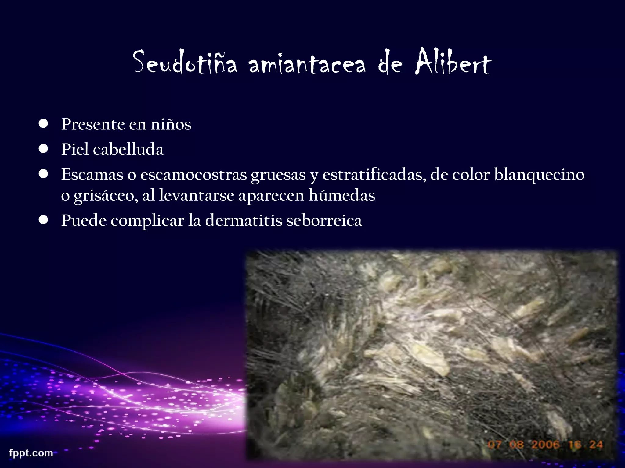 dermatitis seborreica, acne vulgar y rosacea | PPT | Skin and ...
