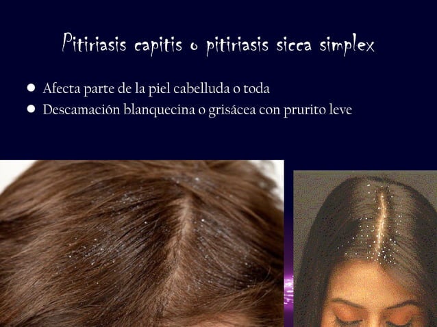 dermatitis seborreica, acne vulgar y rosacea | PPT | Skin and ...
