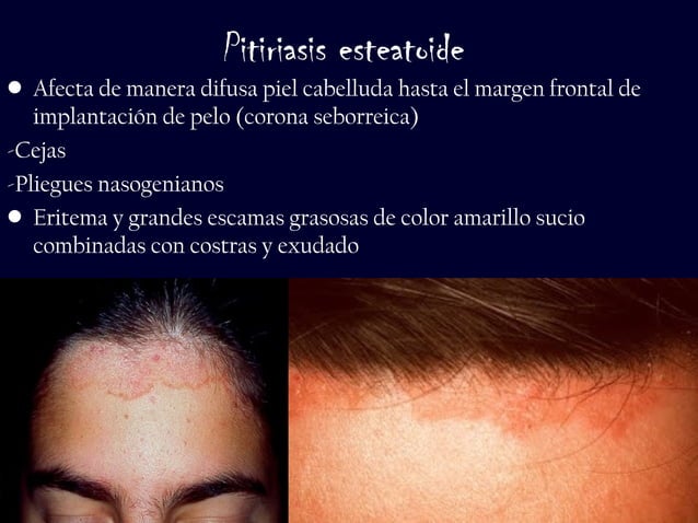 dermatitis seborreica, acne vulgar y rosacea | PPT | Skin and ...