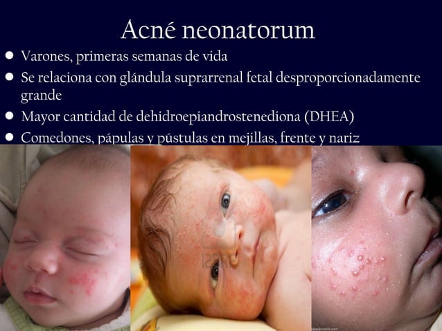 dermatitis seborreica, acne vulgar y rosacea | PPT | Skin and ...