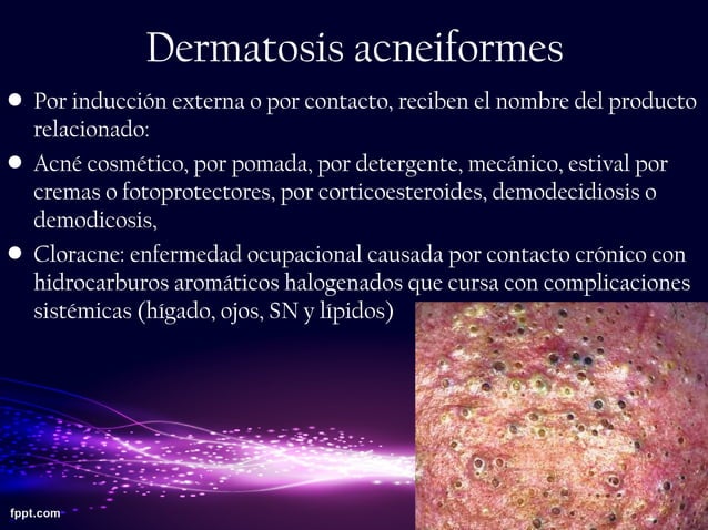 dermatitis seborreica, acne vulgar y rosacea | PPT | Skin and ...