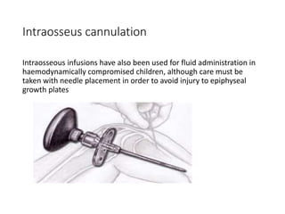 IV Cannulation | PPTX
