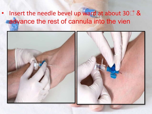 20 iv cannulation | PPTX | Blood Disorders | Diseases and Conditions