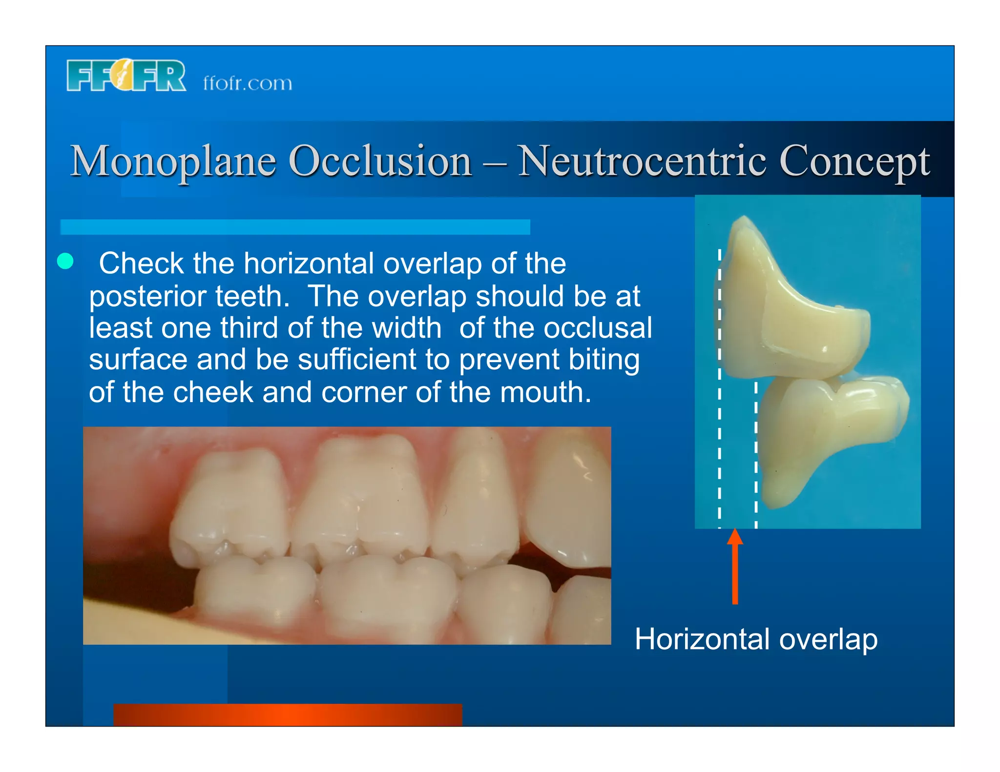 20.(new)occlusal schemes monoplane-neutrocentric concept | PDF
