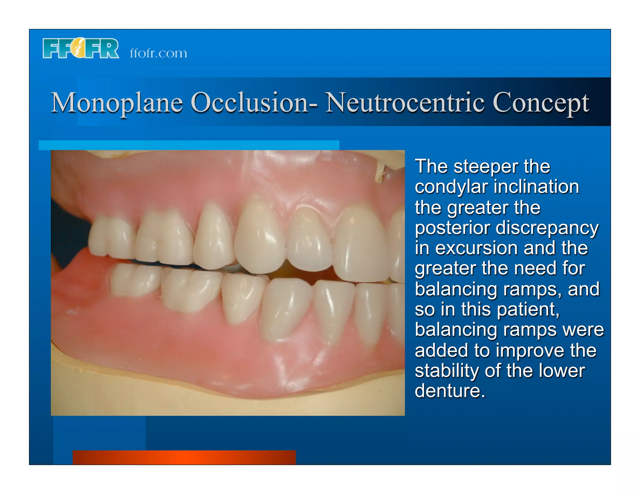 20.(new)occlusal schemes monoplane-neutrocentric concept | PDF