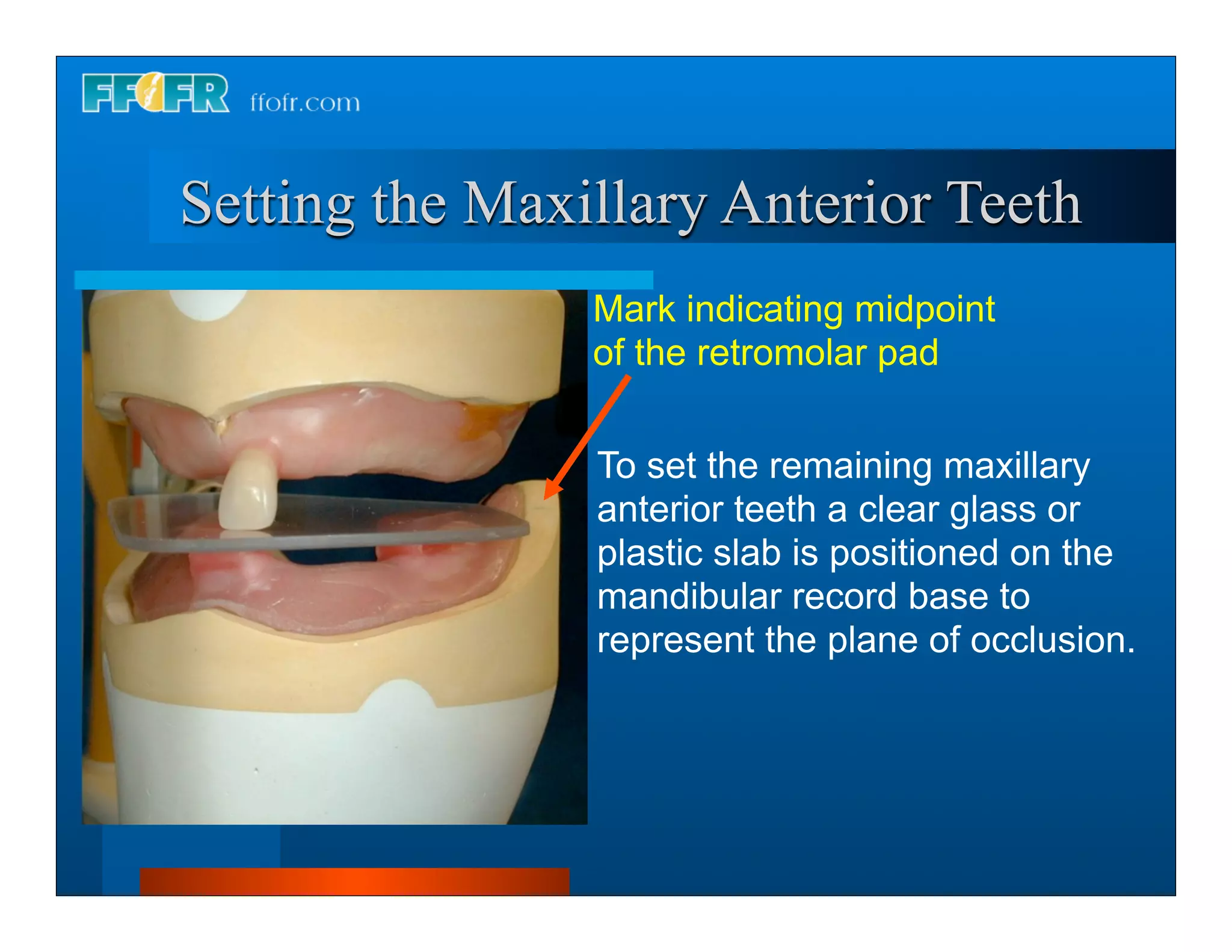 20.(new)occlusal schemes monoplane-neutrocentric concept | PDF