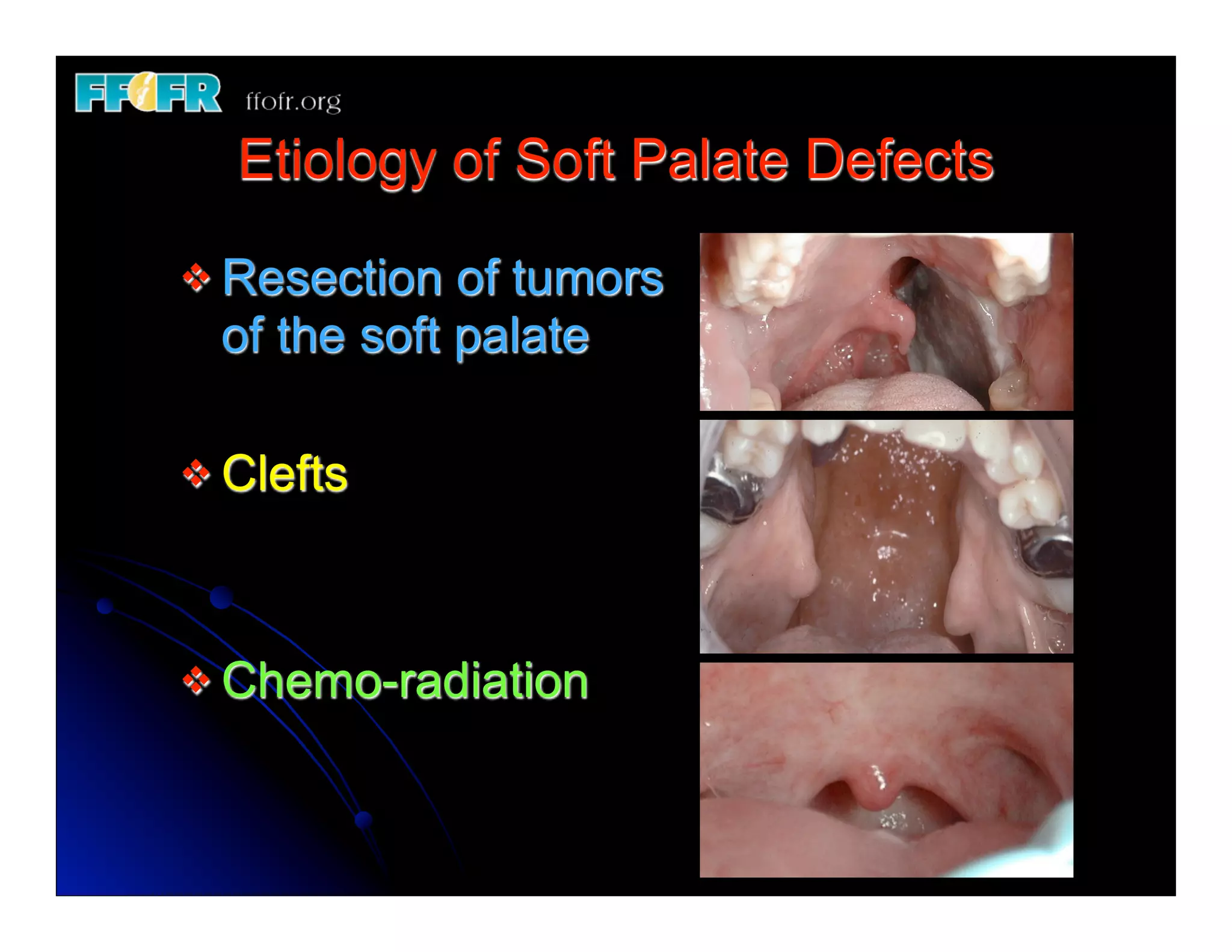 20. (new)restoration of soft palate defects | PDF