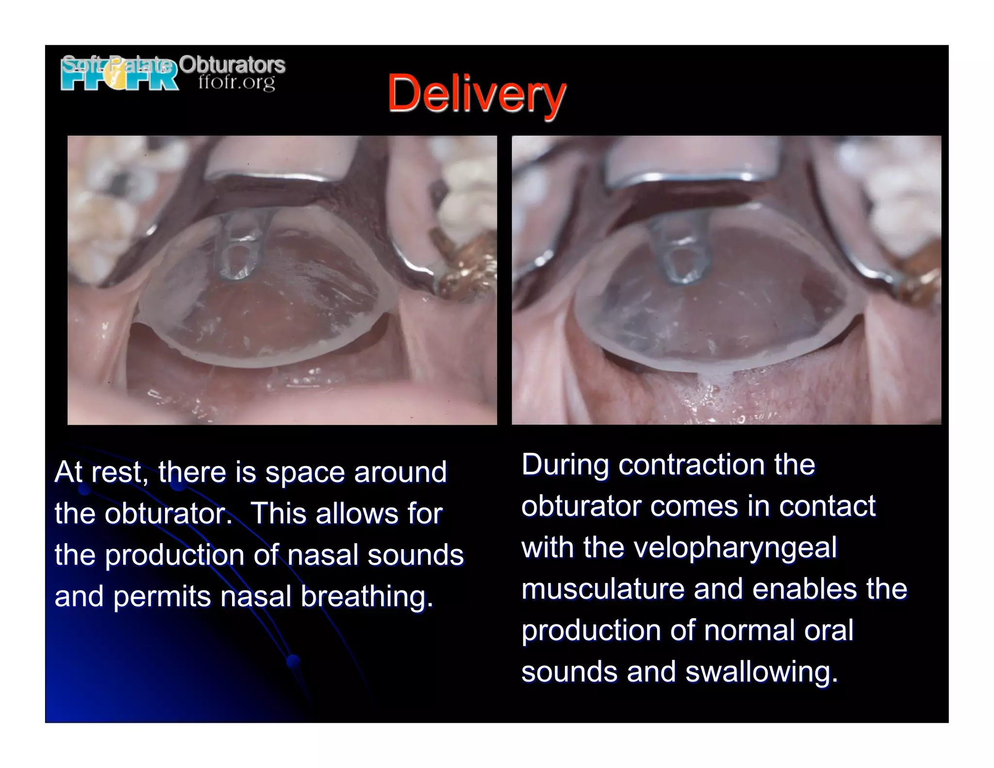 20. (new)restoration of soft palate defects | PPT