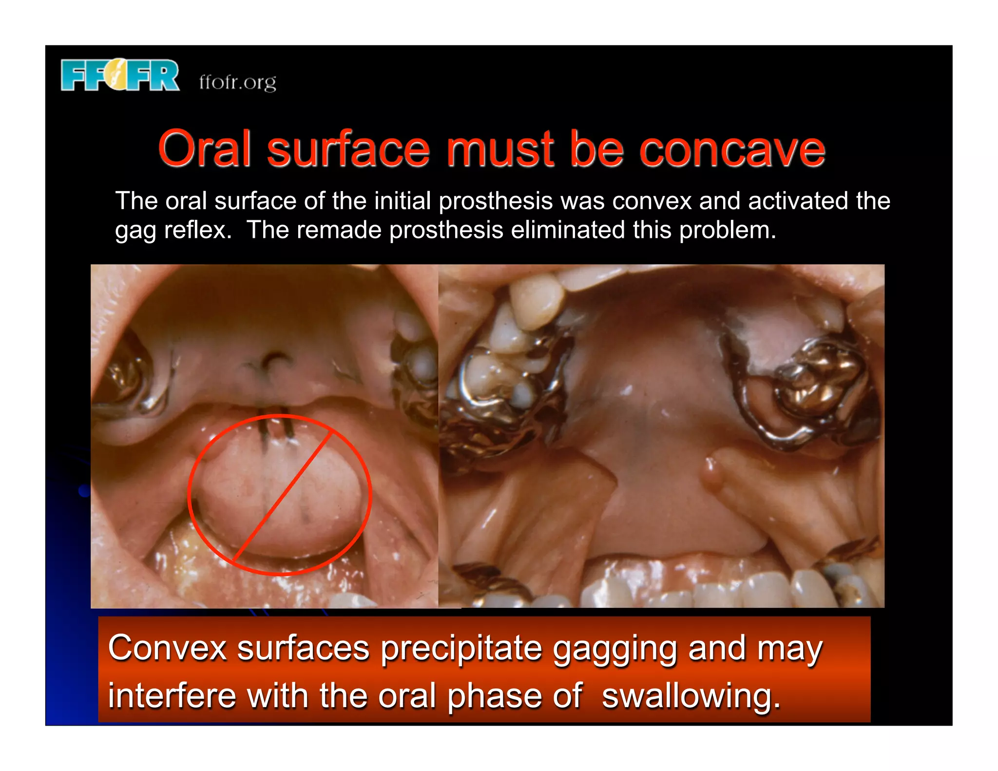 20. (new)restoration of soft palate defects | PDF
