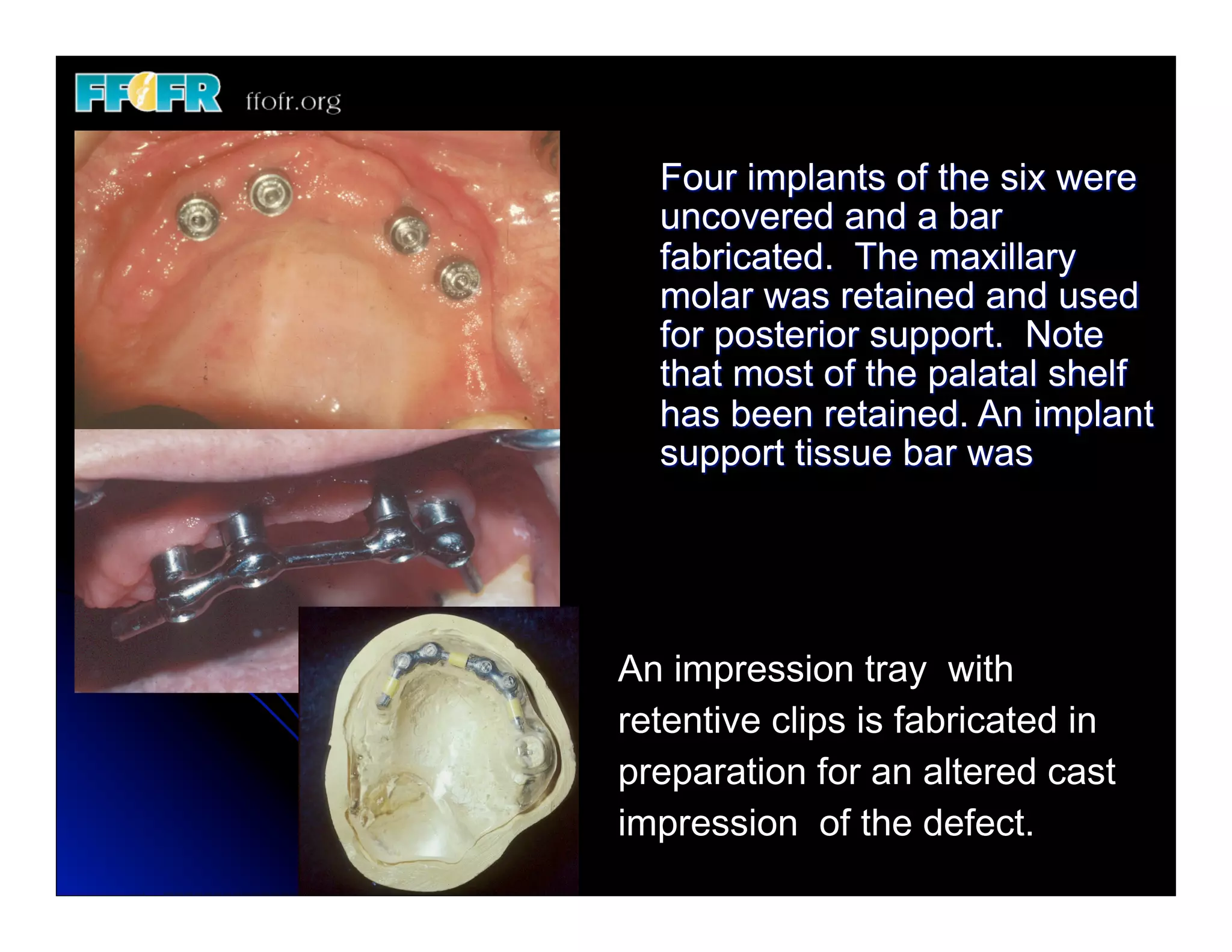 20. (new)restoration of soft palate defects | PDF