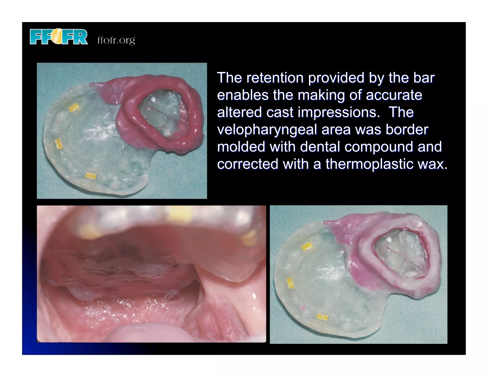 20. (new)restoration of soft palate defects | PDF