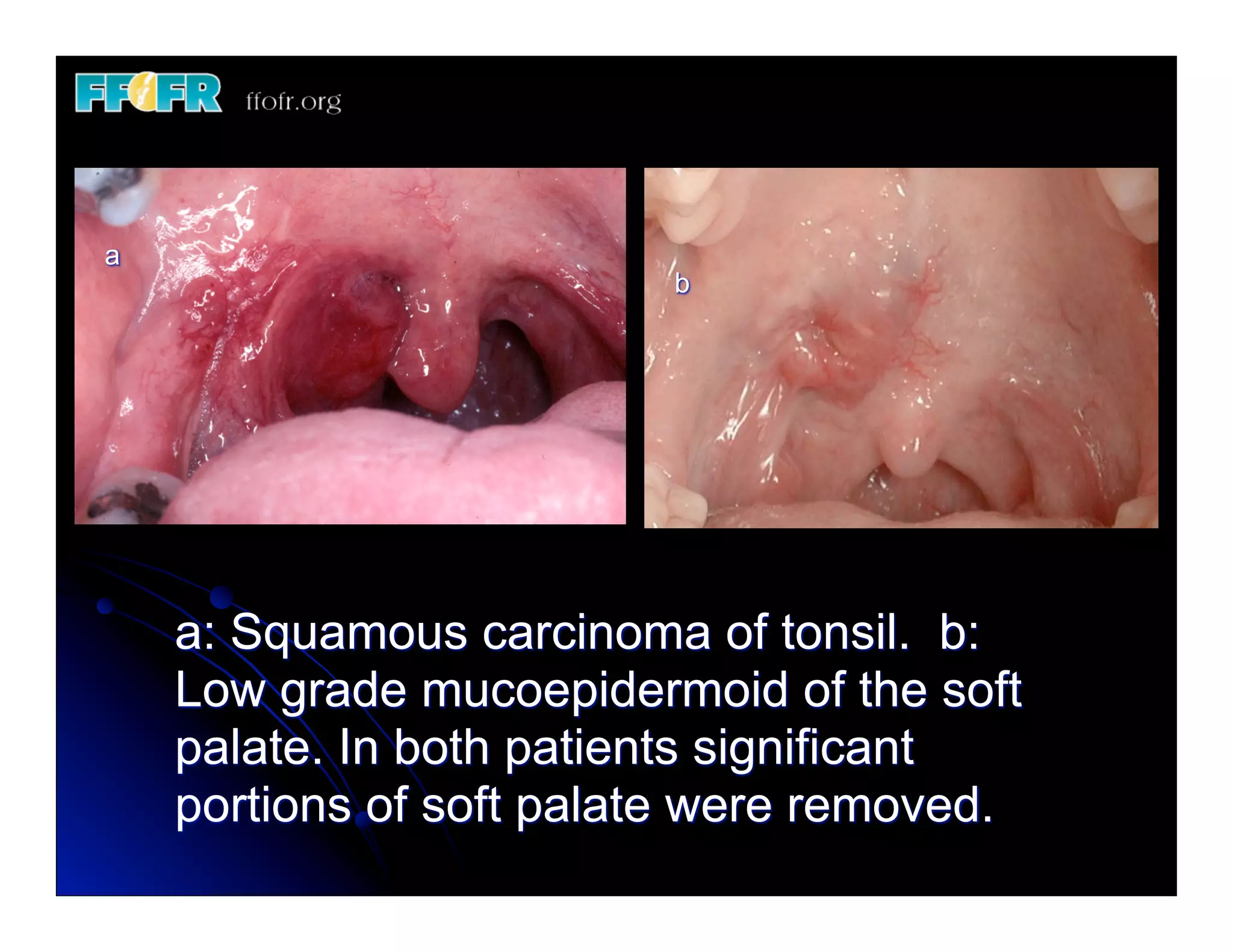 20. (new)restoration of soft palate defects | PDF