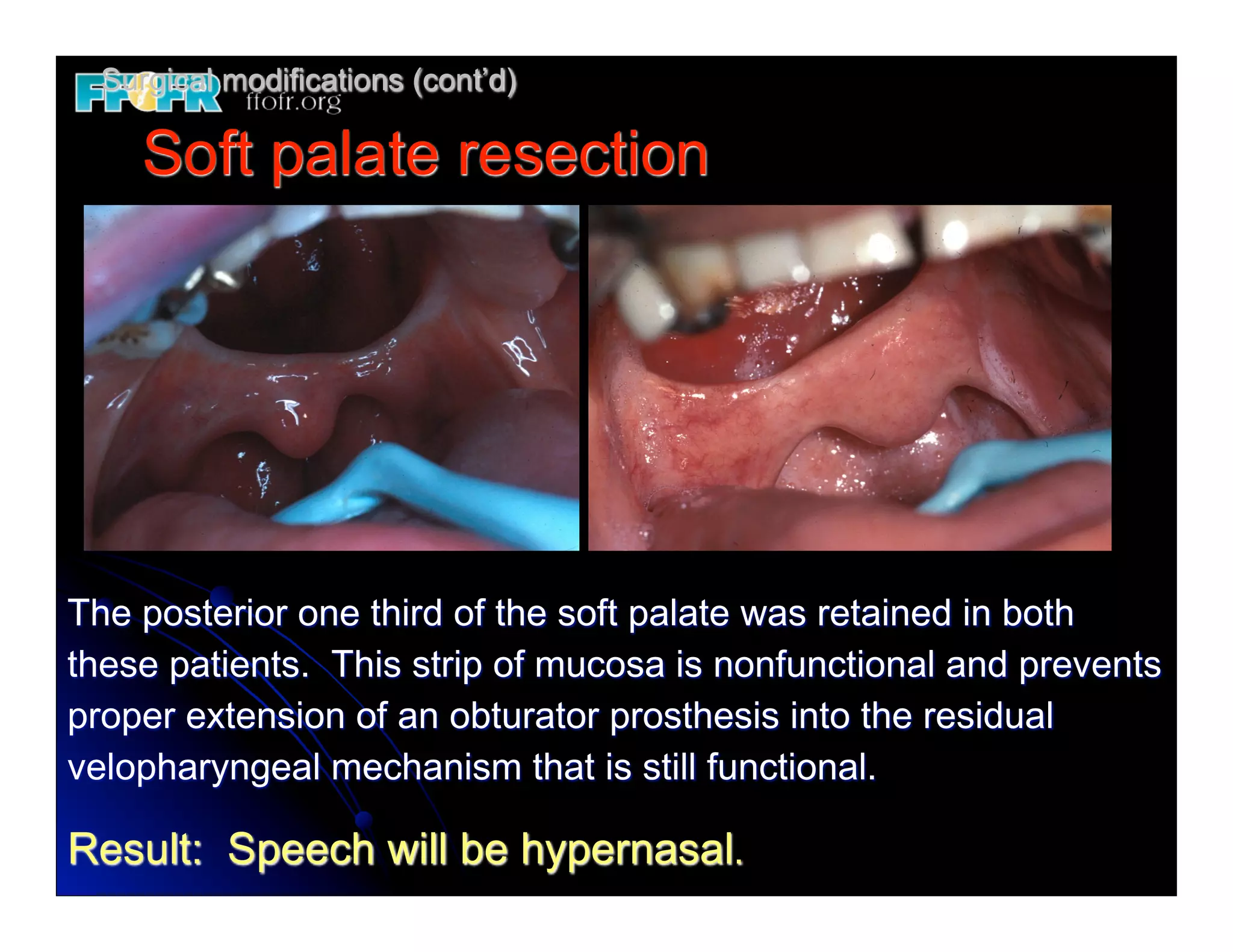 20. (new)restoration of soft palate defects | PDF