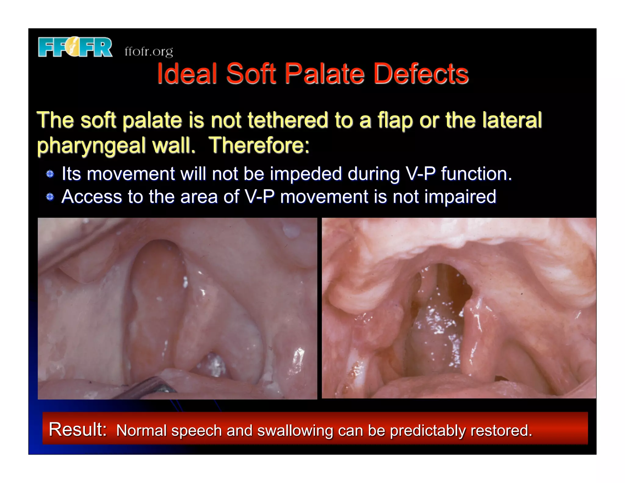 20. (new)restoration of soft palate defects | PDF