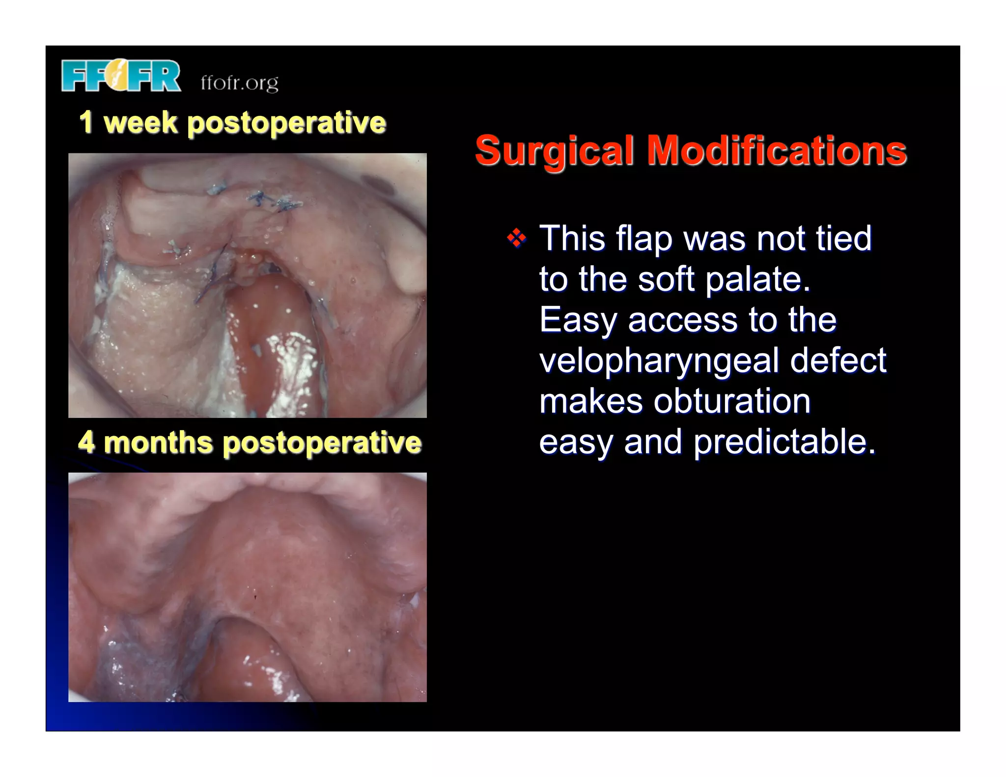 20. (new)restoration of soft palate defects | PDF