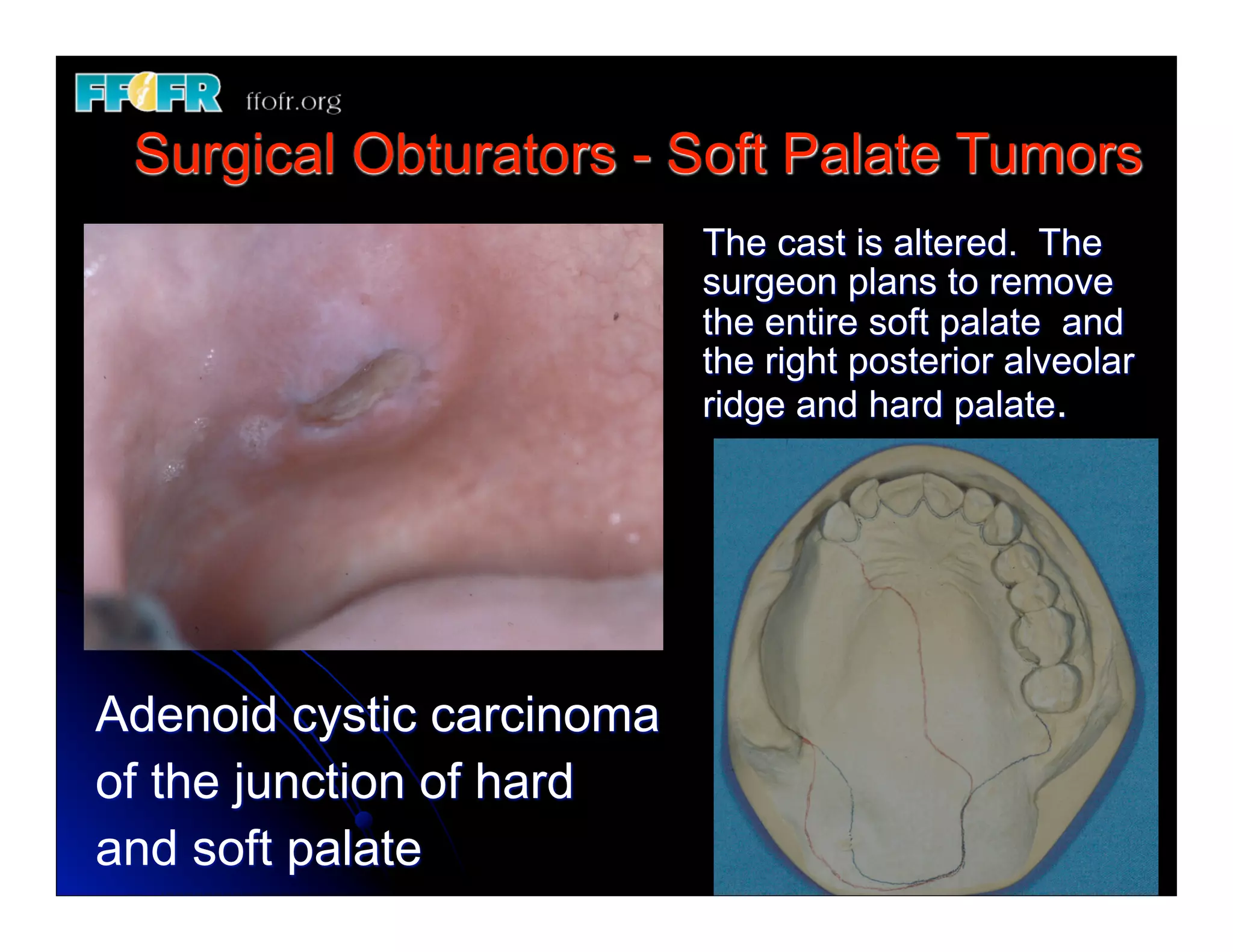 20. (new)restoration of soft palate defects | PPT