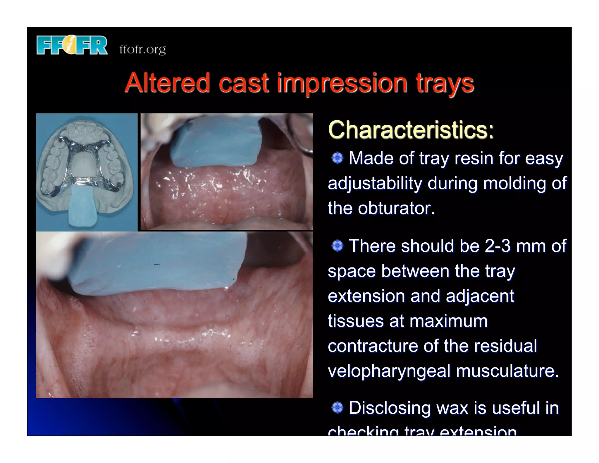 20. (new)restoration of soft palate defects | PDF