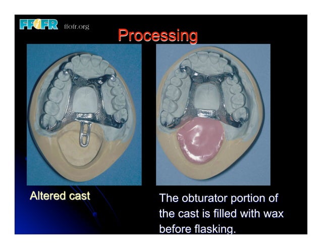 20. (new)restoration of soft palate defects | PDF | Ear, Nose and ...