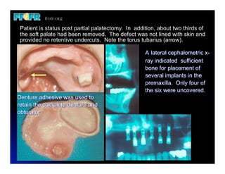 20. (new)restoration of soft palate defects | PDF