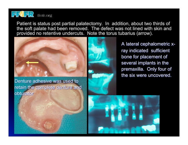 20. (new)restoration of soft palate defects | PDF | Ear, Nose and ...