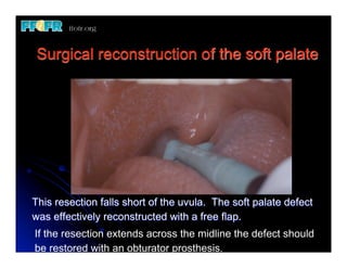 20. (new)restoration of soft palate defects | PDF