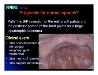 20. (new)restoration of soft palate defects | PDF