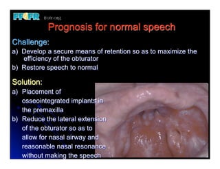20. (new)restoration of soft palate defects | PDF