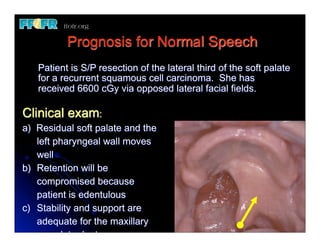 20. (new)restoration of soft palate defects | PDF