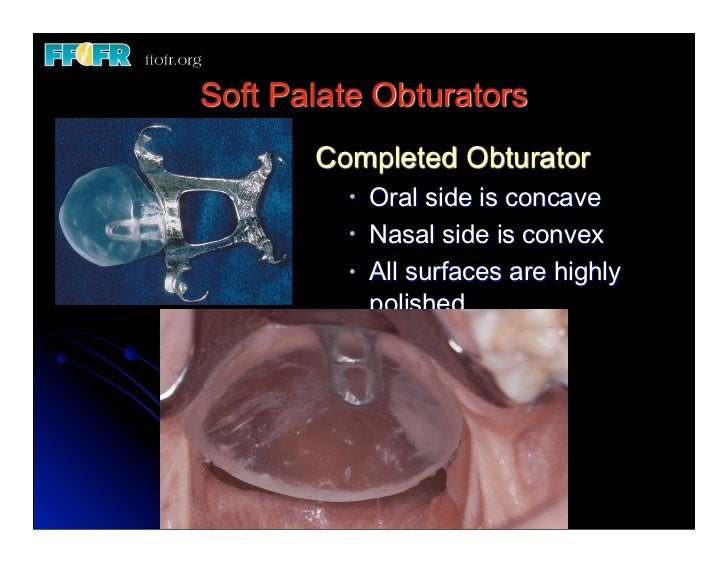 20. (new)restoration of soft palate defects