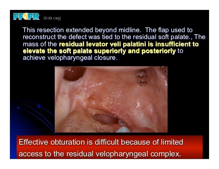 Soft Palate Laceration