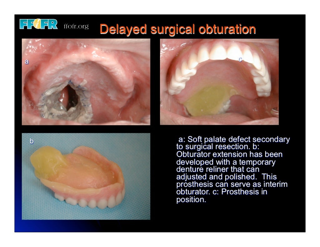20. (new)restoration of soft palate defects