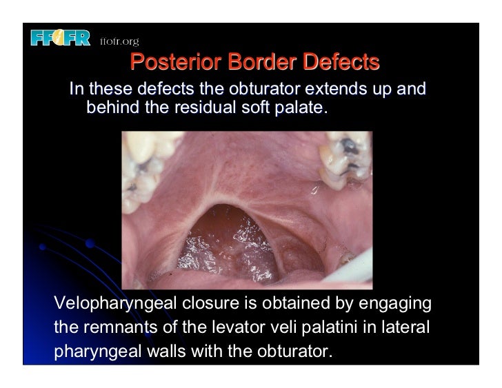 20. (new)restoration of soft palate defects