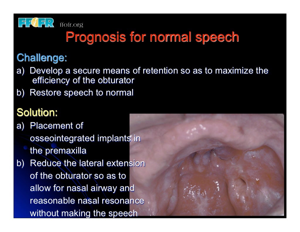 Normal Soft Palate