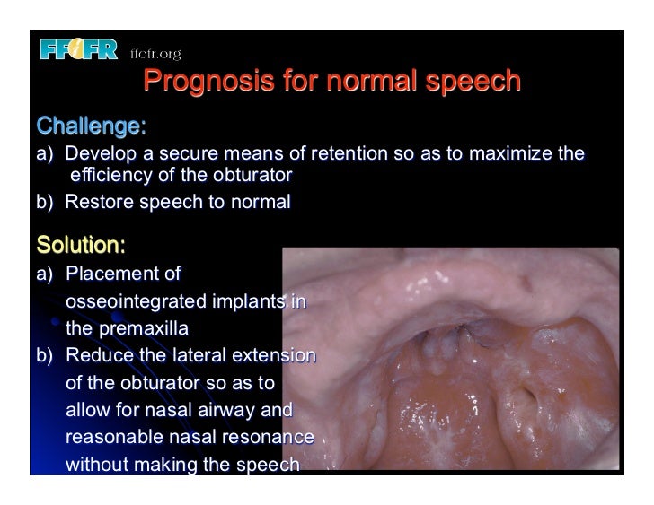20. (new)restoration of soft palate defects