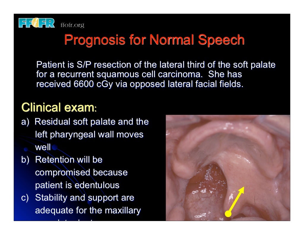 20. (new)restoration of soft palate defects