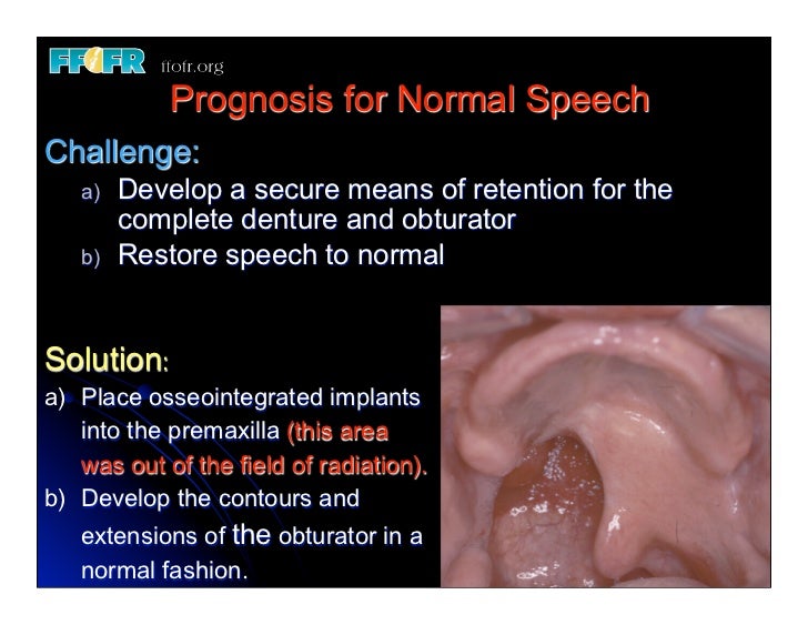 20. (new)restoration of soft palate defects