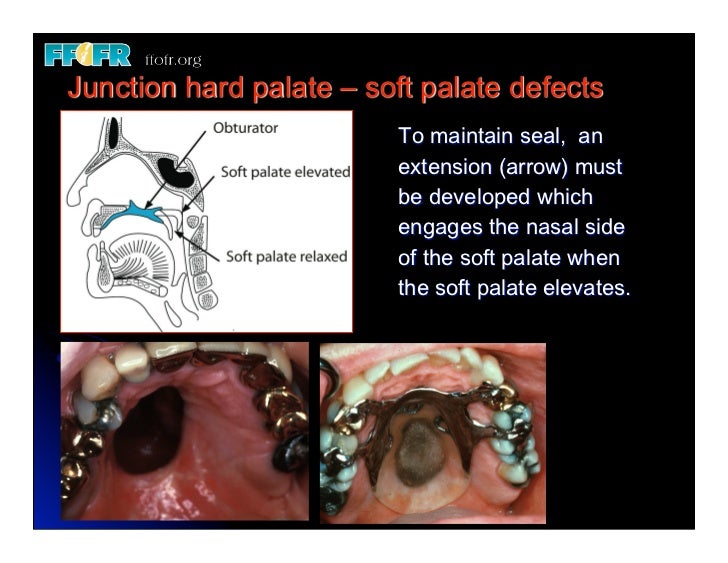 20. (new)restoration of soft palate defects