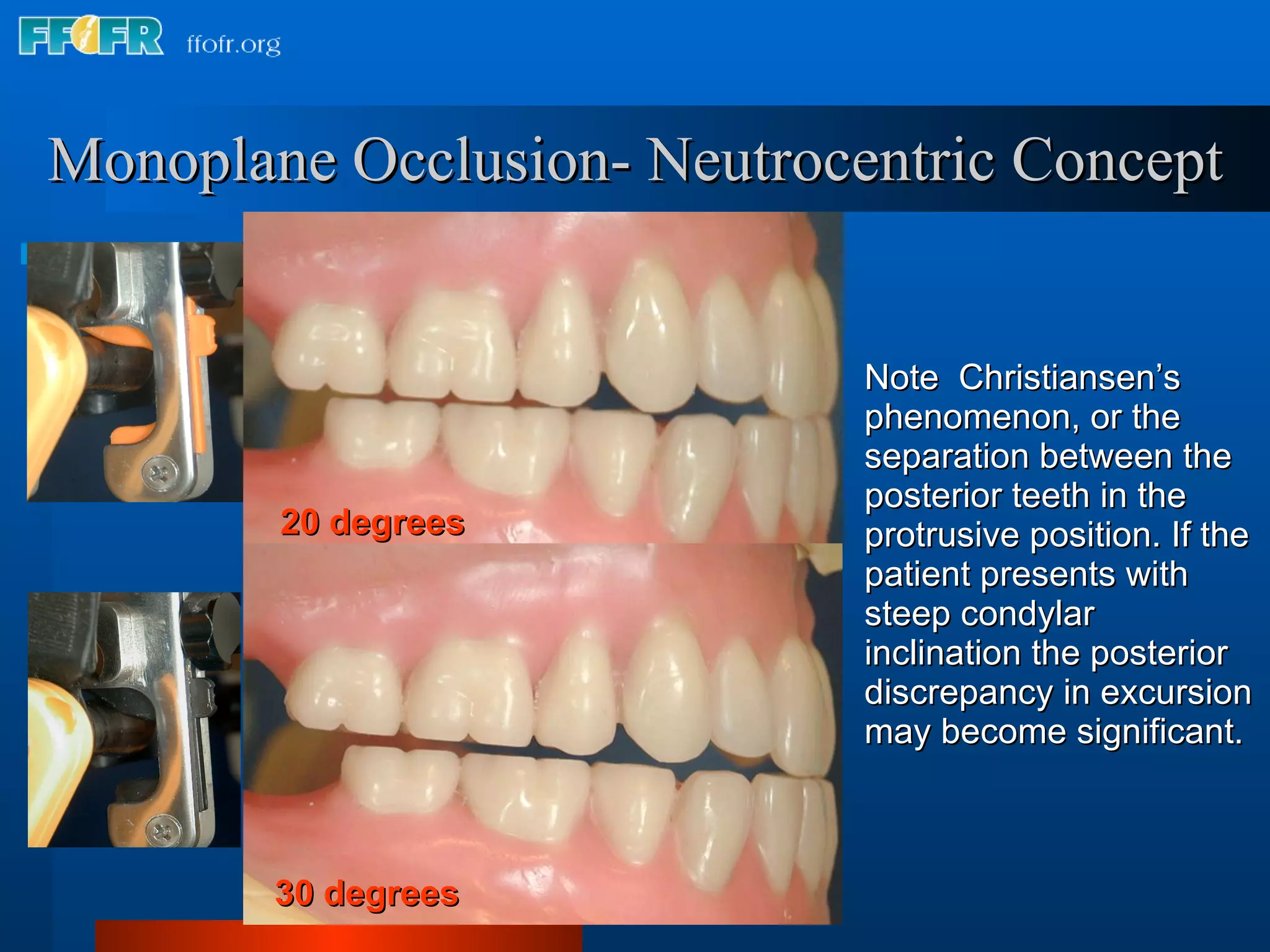 20.occlusal schemes monoplane-neutrocentric concept | PPT
