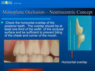 20.occlusal schemes monoplane-neutrocentric concept | PPT