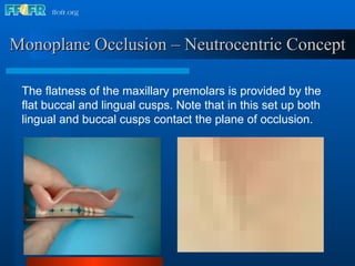 20.occlusal schemes monoplane-neutrocentric concept | PPT
