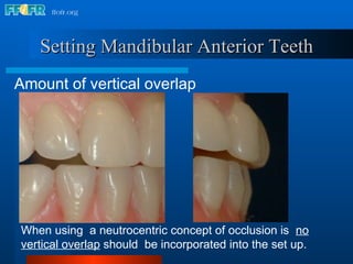 20.occlusal schemes monoplane-neutrocentric concept | PPT