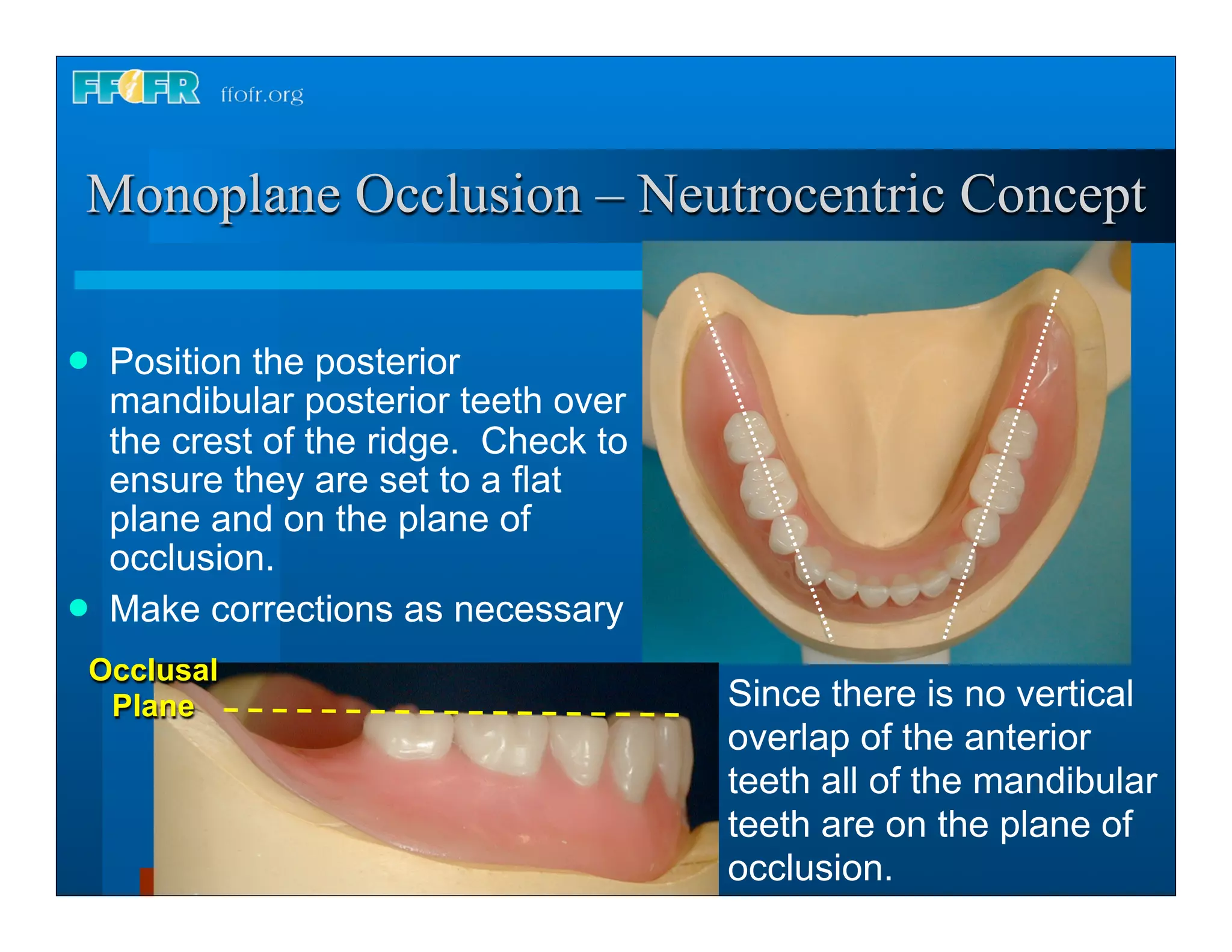 20.occlusal schemes monoplane-neutrocentric concept | PDF