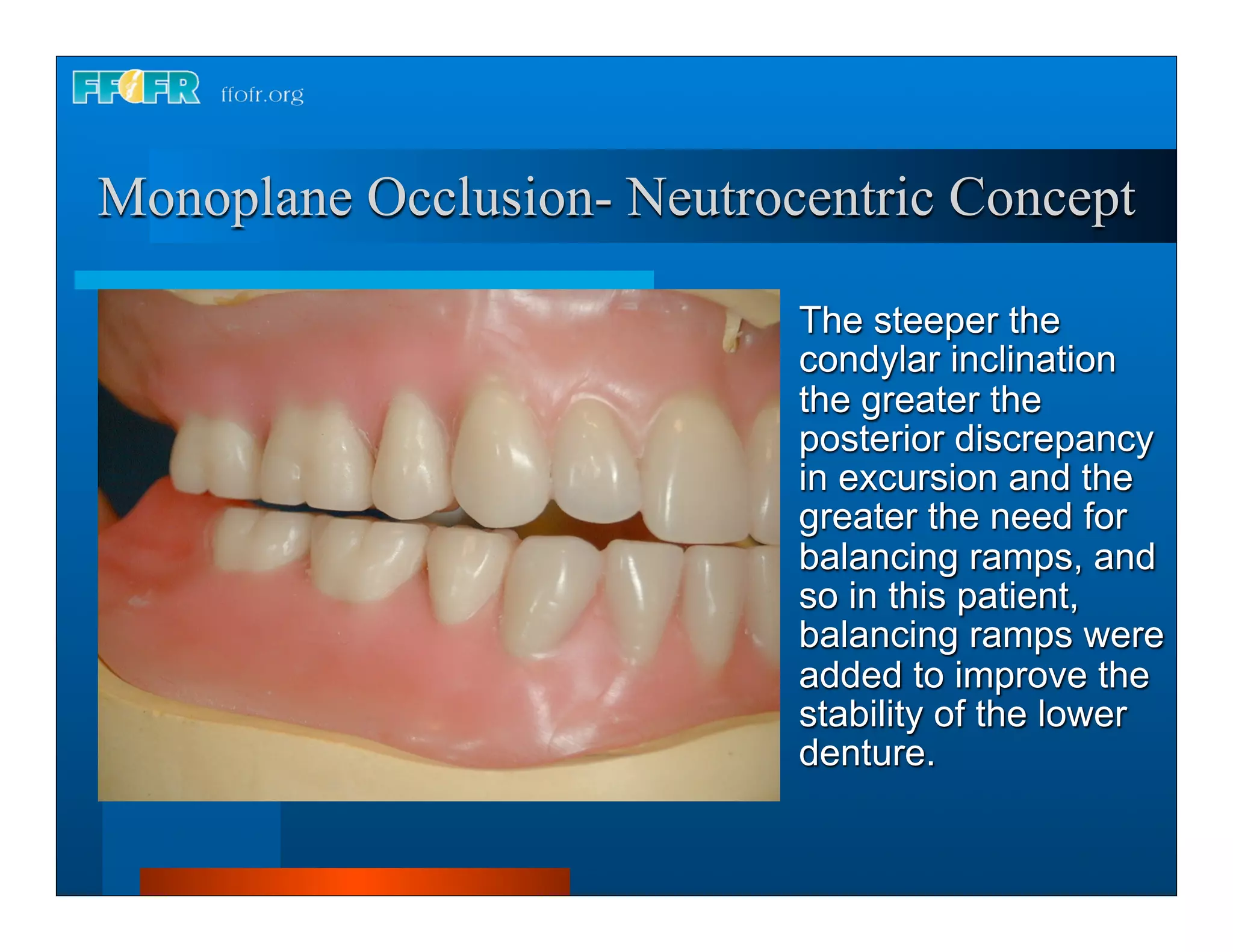 20.occlusal schemes monoplane-neutrocentric concept | PDF