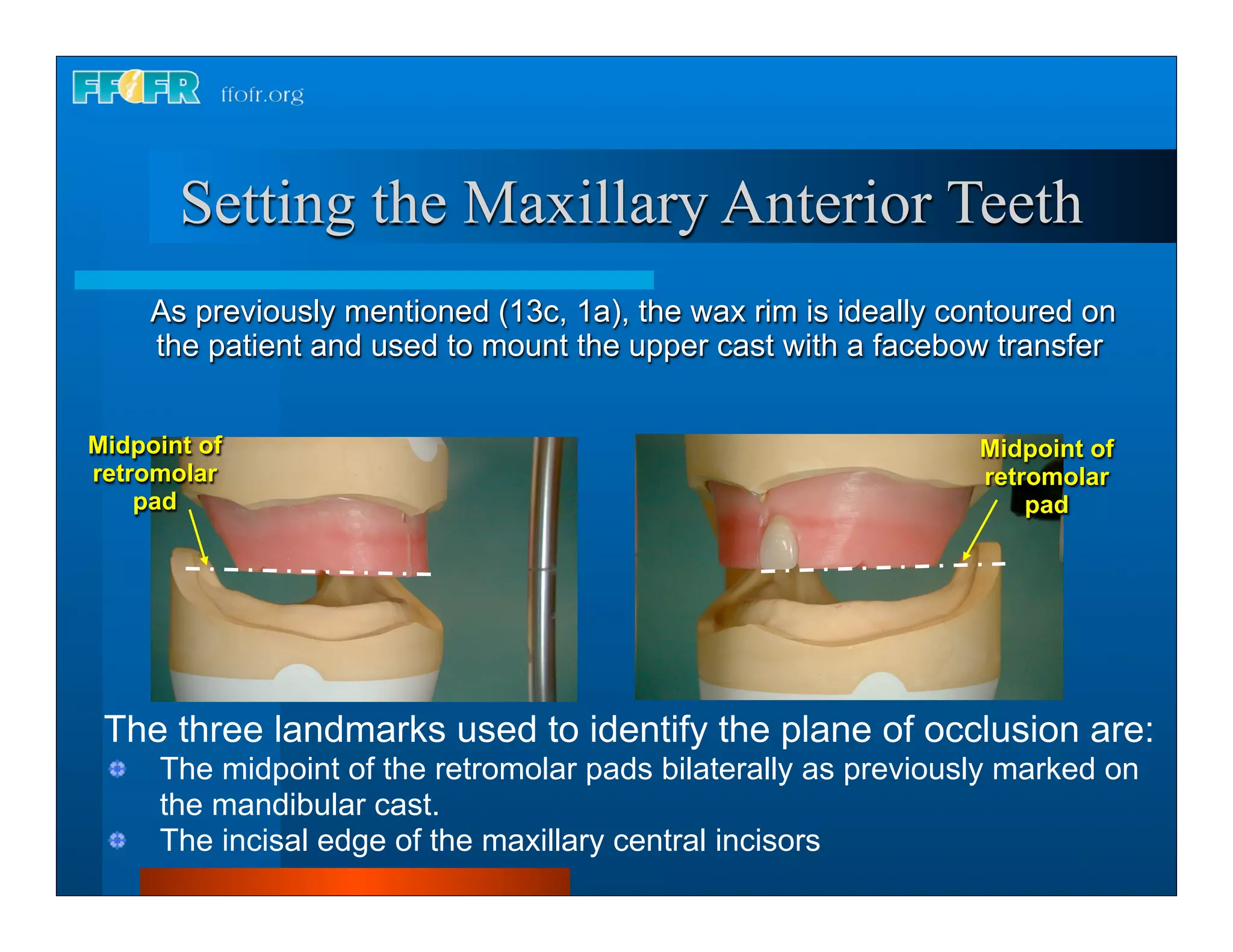 20.occlusal schemes monoplane-neutrocentric concept | PDF