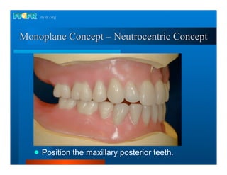 20.occlusal schemes monoplane-neutrocentric concept | PDF