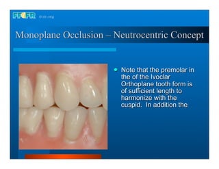 20.occlusal schemes monoplane-neutrocentric concept | PDF
