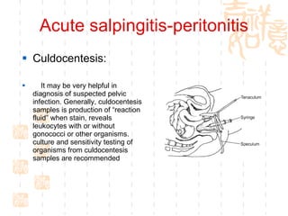 20.Pelvic Inflammatory Disease | PPT