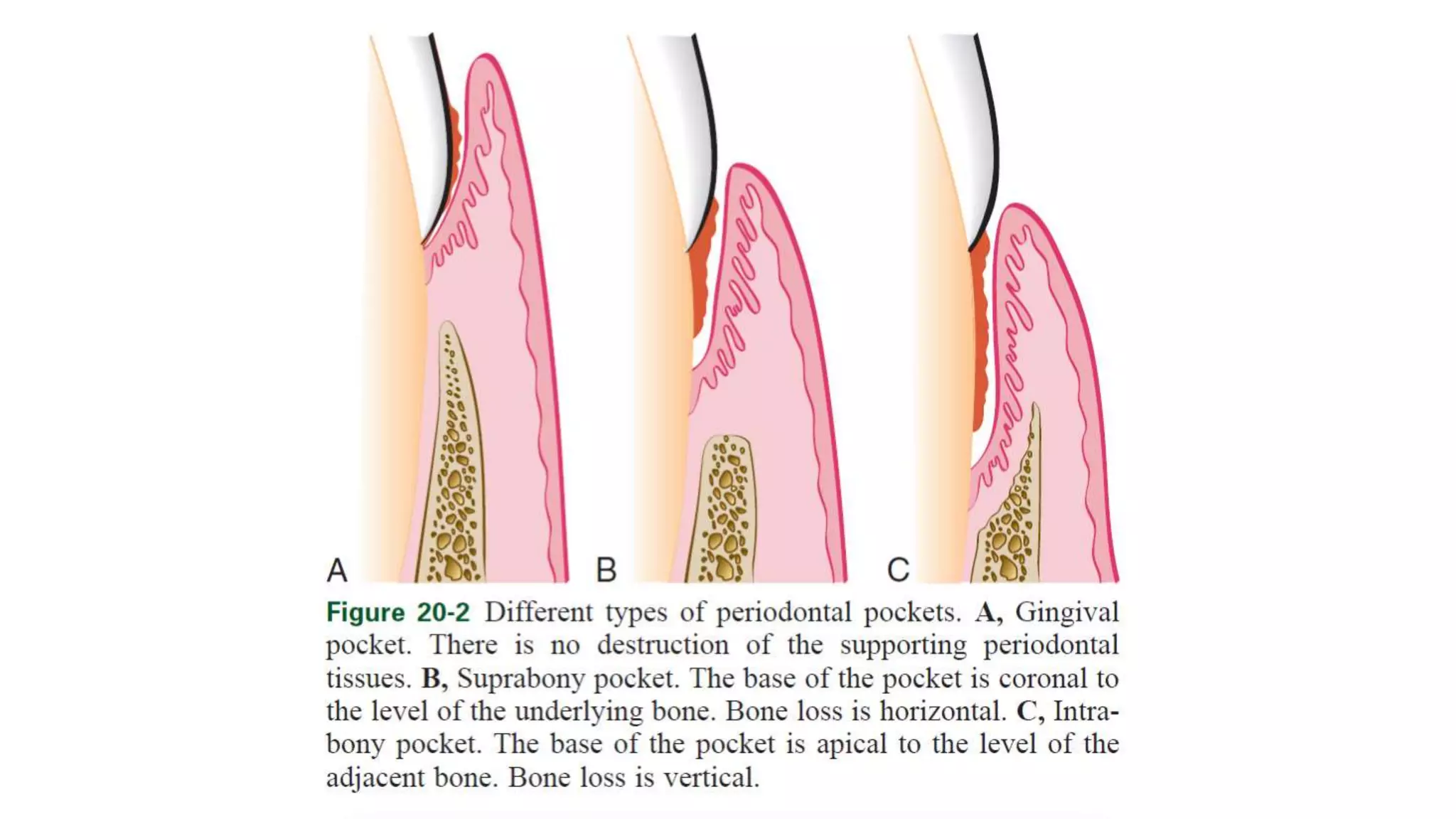 Carranza 2015, 12th edition, Chapter 20, The Periodontal Pocket | PPT