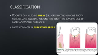 Carranza 2015, 12th edition, Chapter 20, The Periodontal Pocket | PPTX